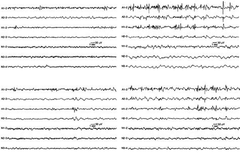 Intraoperative Ecog Recording In A Patient With Right Mesial Temporal Download Scientific
