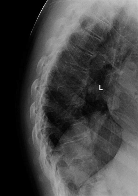 Lateral X Ray Showing Flowing Ossification Along Mid Inferior Aspects