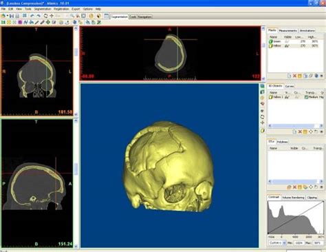 Craniofacial Reconstruction Innovative Delta Technology Llc