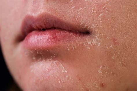 What Causes Flaky Skin After Face Wash Deyga Organics