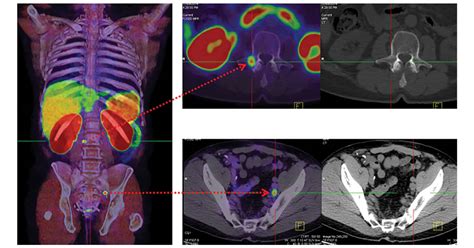 Bone Scan In Prostate Cancer