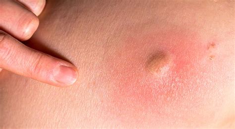 Abses Penyebab Gejala Pencegahan Dan Pengobatan By Dr Septiani