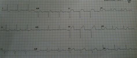 Dr Smiths Ecg Blog New Upright T Wave That Is Not Pseudonormalization