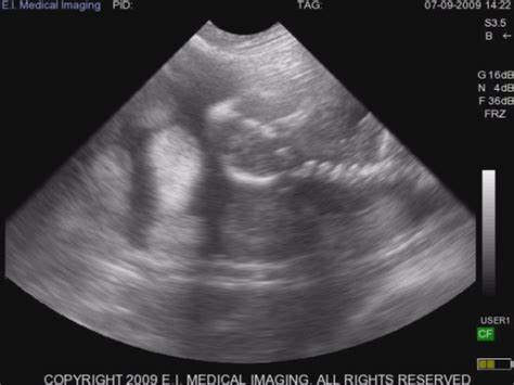 Using Portable Ultrasound For Early Pregnancy Detection In Sheep