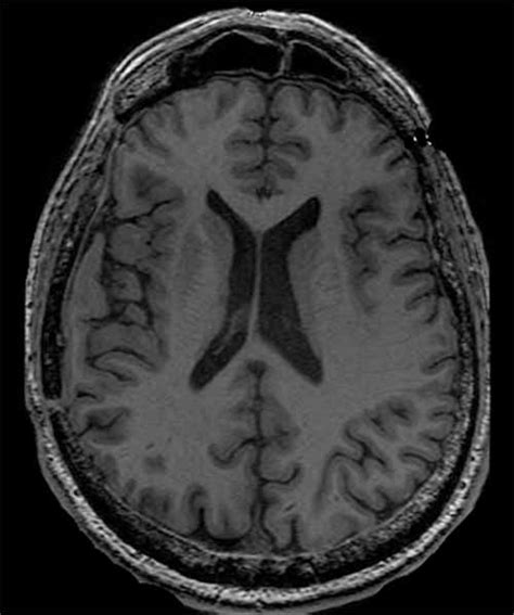 T1 T2 And Pd Weighted Imaging Radiology Cafe