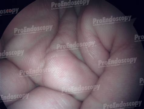 Stryker 502 477 071 4mm 70 Degrees Speedlock Autoclavable Arthroscope