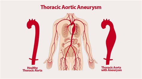 Abdominal Aortic Aneurysm Symptoms Causes And Treatment Specialty