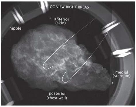 Oncoplastic Breast Surgery Basicmedical Key