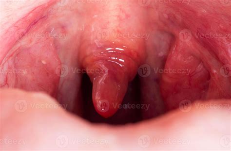 Inflamación De El úvula En El Oral Cavidad Debido A Infección Y Virus