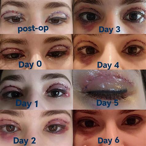 Revision Blepharoplasty For Previous Eyelid Surgery Concerns