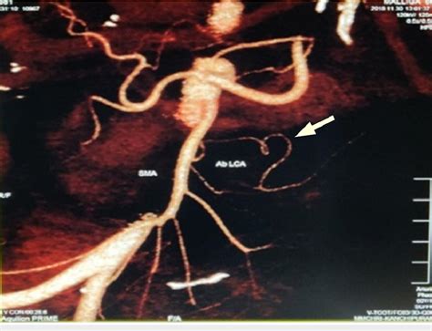 Ct Angiogram Denoting Ab Lca Ct Angiogram Of Abdomen Denoting Ab Lca