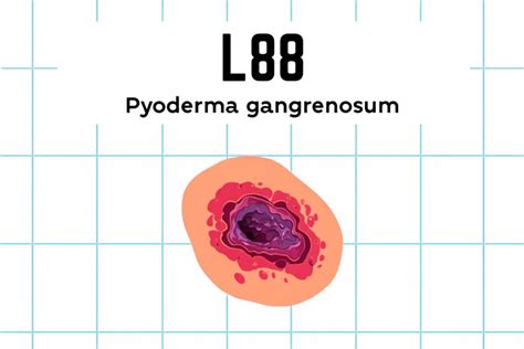 L88 Icd10 Code For Pyoderma Gangrenosum