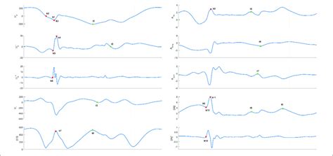 Features Used On The Kinematic Signals Recorded By The Foot Worn