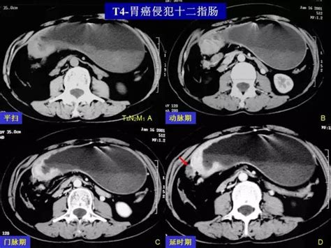 胃癌ct诊断报告 胃癌诊断报告真实图片 伤感说说吧