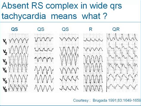 Wide Qrs Tachycardia Vt Svt Aberrancy Brugada Dr S Venkatesan Md