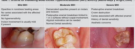 Table 1 From Prevalence Of Molar Incisor Hypomineralization Mih In