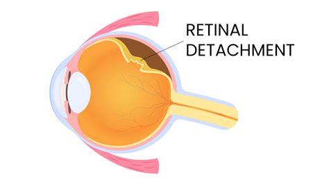 Retinal Detachment Causes Symptoms And Treatment