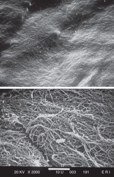 Vitreous And Vitreoretinal Interface Ento Key