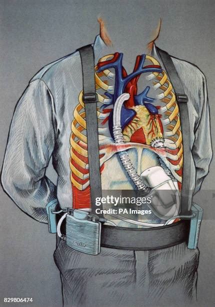 Ventricular Assist Device Photos And Premium High Res Pictures Getty