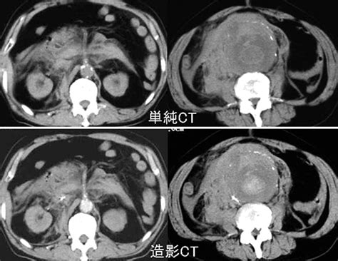 174 ） 60 歳代、男性。 腹部拍動性腫瘤と貧血。