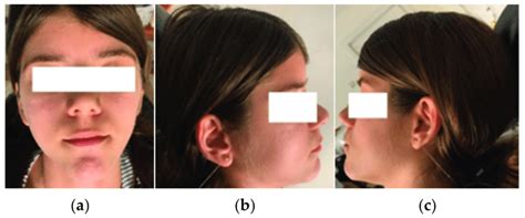 Front A Right B And Left C Profile Photos Of The Patient Download Scientific Diagram