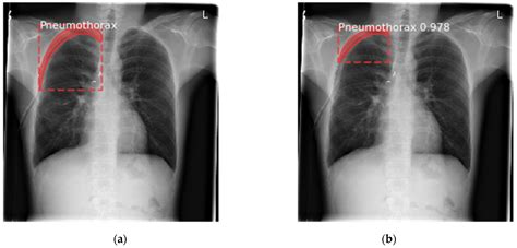 pneumothorax chest x ray