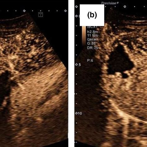 Echinococcus Multilocularis Ulm Classification—ultrasound Emuc Us [10] Download Scientific