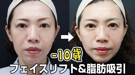 【フェイスリフトand脂肪吸引】手術後1ヶ月の劇的変化【 10歳】 Youtube