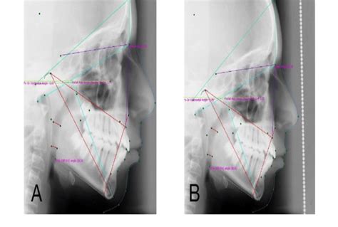 A Traced Cephalograma A Lateral Cephalogram Aquired In Nhp Traced By