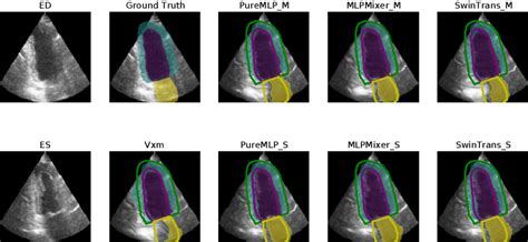 Unsupervised Echocardiography Registration Through Patch Based Mlps And