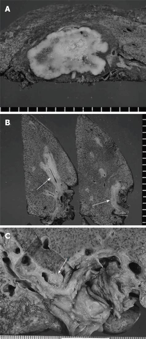 Figure 1 From Pathological Classification Of Intrahepatic