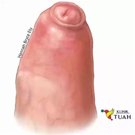 Phimosis Breaking The Silence On A Common Yet Overlooked Issue