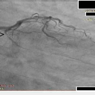 Angiogram Of LCX Coronary Artery Showing Severe Distal Download Scientific Diagram