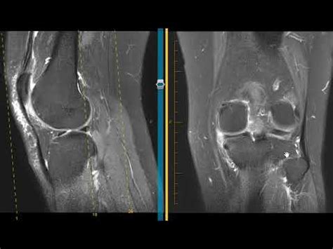 Is That A Meniscus Tear Your Mri Explained In 5 Easy Steps