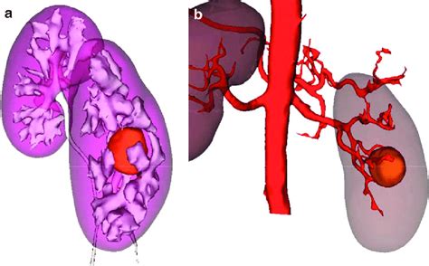 Reconstructed 3d Digital Model Depicted Intraparenchymal Mass Clearly Download Scientific