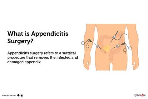 Appendicitis Surgery Purpose Procedure Benefits And Side Effects