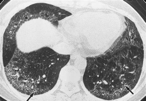 Mixed Connective Tissue Disease And Usual Interstitial Pneumonia Ct Download Scientific