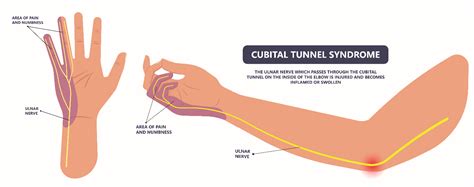 Compression Du Nerf Ulnaire Dr Sturbois Nachef