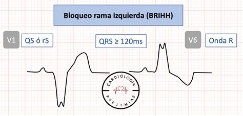 Intervalo Qt Ecg 2025