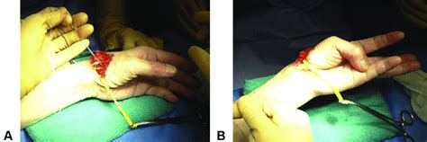 Suture Suspension Arthroplasty For Thumb Cmc Arthropathy It Is Download Scientific Diagram
