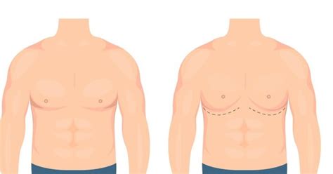 The Psychological Impact Of Gynecomastia On Men Dr Dash