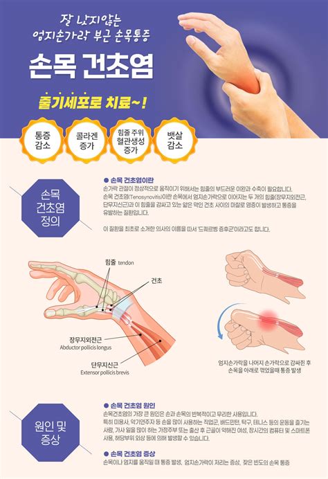 줄기세포로 손목통증 유발하는 손목 건초염 개선