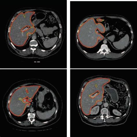 examples of the limiting factors for liver segmentation in ct images download scientific diagram