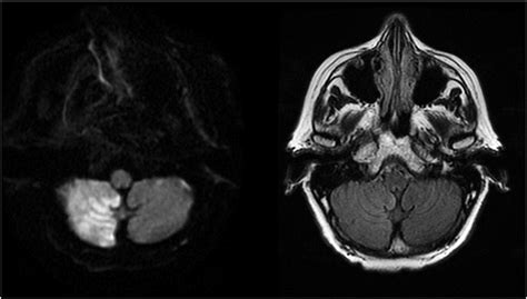 complete dwi flair mismatch of a right cerebellar infarct download