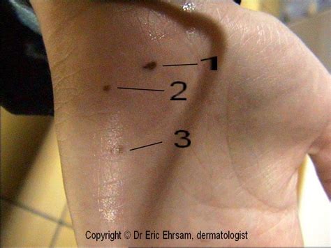Dermoscopy Parallel Furrow Pattern