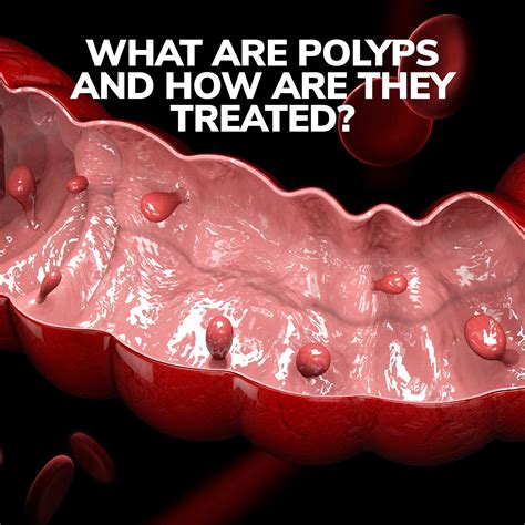 What Are Polyps Gastroenterology Of Greater Orlando