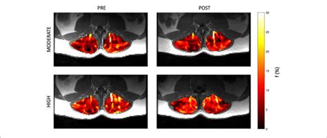 Representative Parameter Maps Of Perfusion Fraction F Before And Download Scientific