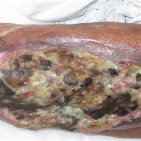Pyoderma Gangrenosum At Initial Presentation Download Scientific Diagram