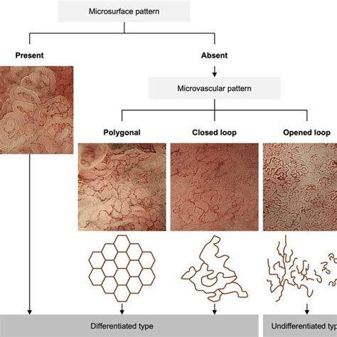 Diagnostic Algorithm Of Magnifying Narrow‐band Imaging For Download Scientific Diagram