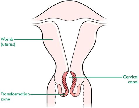 Cervical Ectropion Causes Symptoms And Cervical Ectropion Treatment